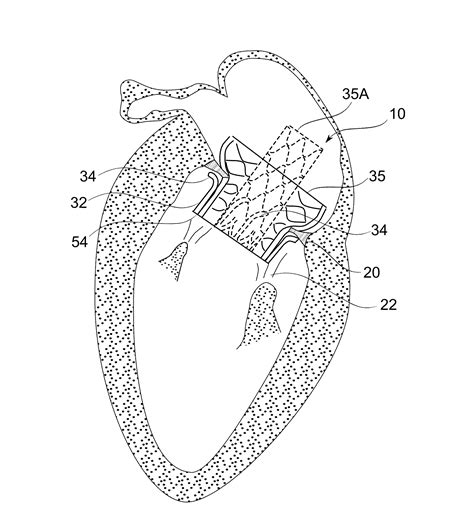 Prosthetic Mitral Valve Patented Technology Retrieval Search Results Eureka Patsnap