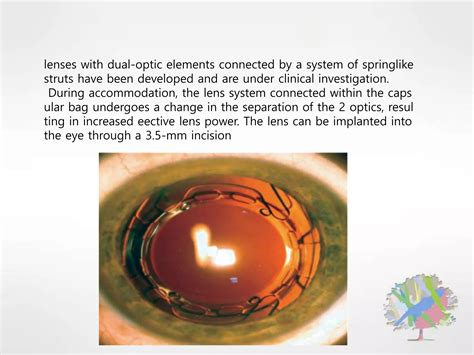 Presbyopia Part 1 Lenticular Approach Types Of Mfiol Pptx