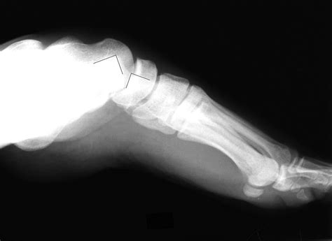 Calcaneocuboid Dislocation