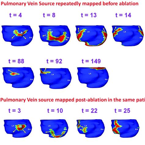 Macro Reentry In Persistent Af Propagating Wavefront Is Shown In