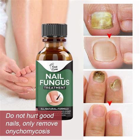 Nail Fungus Treatment Best Nail Repair Stop Fungal Growth Effective Fingernail Toenail
