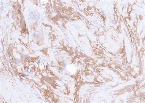 A Separate Fibrous Fragment With Psammomatous Calcifications And Download Scientific Diagram