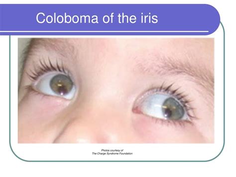 Ppt The Visual Implications Of Charge Syndrome Powerpoint