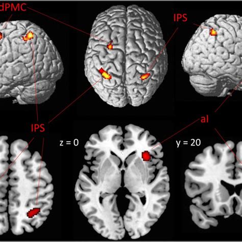 Differences In Convergence Of Brain Activation Between Dual Tasking