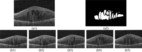 a1 an oct b scan containing cysts and a2 its cysts presented with