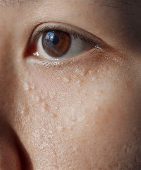 Milia What Are They And How To Treat Them Naturally Edible Beauty