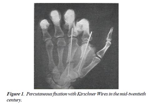 The Cost Of Quality Open Reduction And Internal Fixation Techniques Versus Percutaneous K Wire