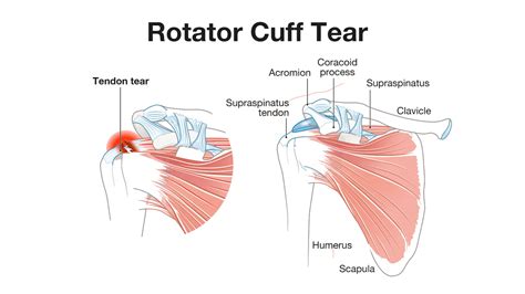 Rotator Cuff Tear First Choice Health
