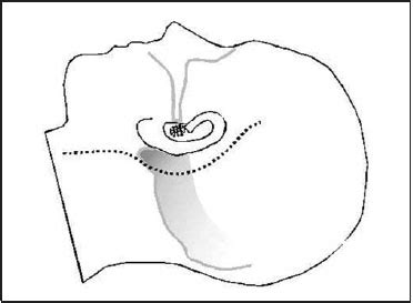 Infratemporal Fossa Approaches Ento Key