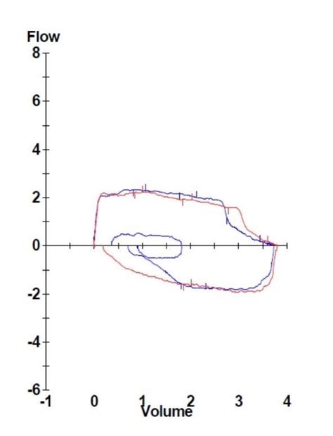 Flow Loop Demonstrating Fixed Large Airway Obstruction Download Scientific Diagram