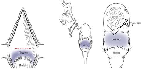 Kasr Alainy Simplified Uterine Preserving Surgery For Conservative Management Of Placenta