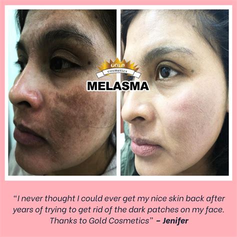 Can Cosmetics Cause Melasma Facial Adviser