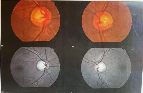 Need Your Opinions On My Glaucoma Suspect Rglaucoma