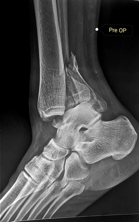 Hasith Chathuranga On Linkedin Radiology Radiographer Radiologictechnologist Dayinthelife