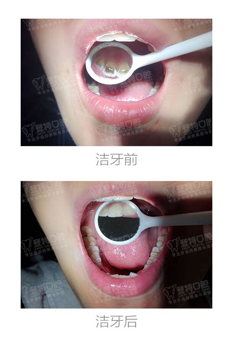 洗牙效果图 洗牙卡通图片 第11页 大山谷图库