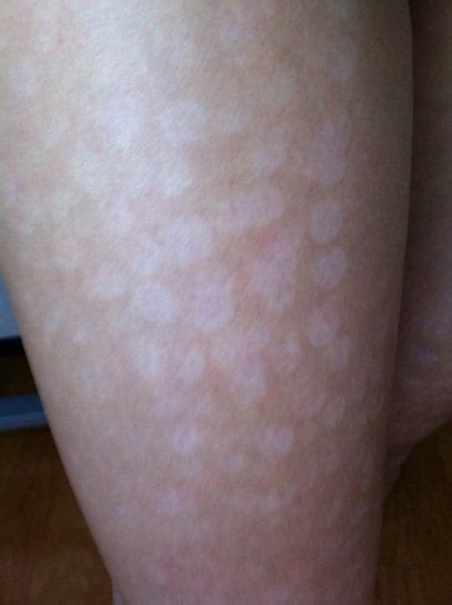White Ps On Face After Laser Hair Removal Infoupdate Org