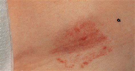 Physician Diagnosed Erythema Migrans And Erythema Migranslike Rashes Following Lone Star Tick