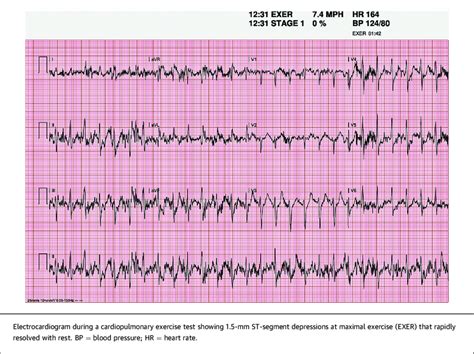 Maximal Exercise Electrocardiogram Download Scientific Diagram