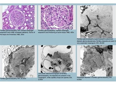 Mesangial Proliferative Gn