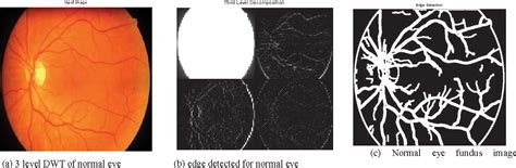 Figure 2 From Automatic Cataract Classification System Semantic Scholar