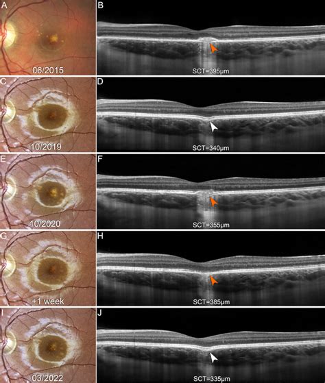 Representative Case Of Punctate Inner Pachychoroidopathy Cluster 2