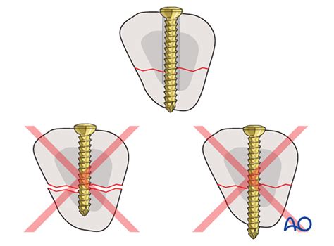 Lag Screw Fixation For Simple Oblique Fracture Of The Diaphysis