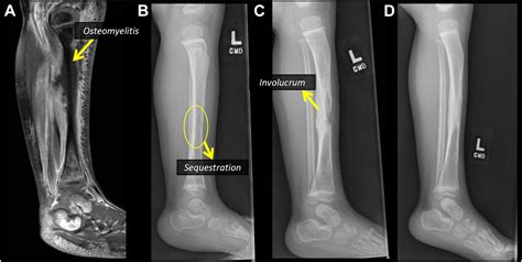 Sequestration And Involucrum Orthopedic Clinics