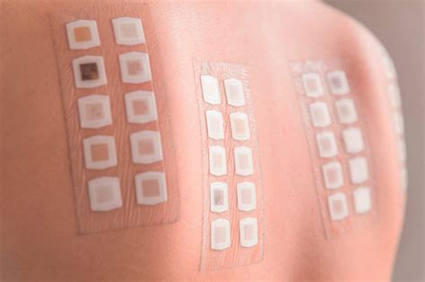 Contact Dermatitis Patch Testing Techniques Hope Dermatology