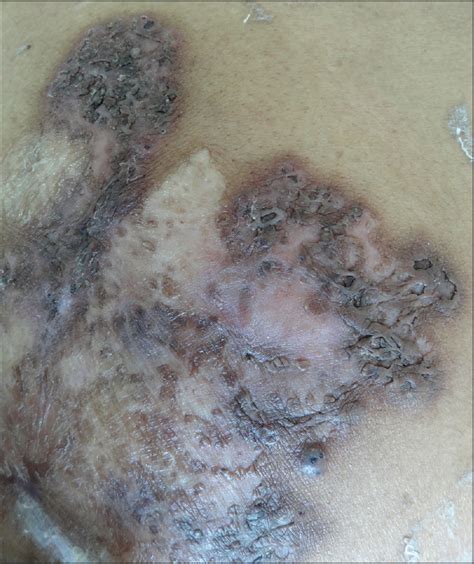 Superficial Granulomatous Pyoderma A Great Mimicker Indian Journal Of Dermatology