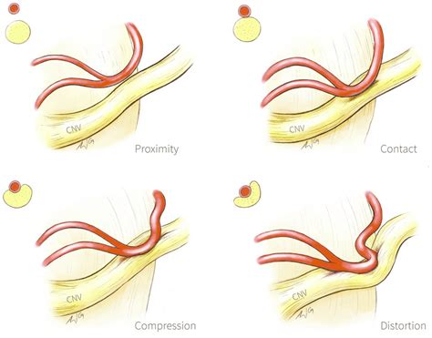 Trigeminal Nerve Vessel Relationships A Schematic Illustration Download Scientific Diagram