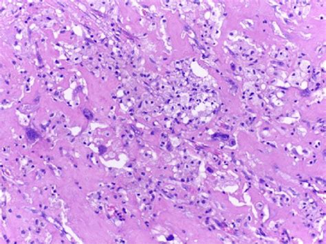 Detail Of Figure 3 For The Appearance Of Pleomorphic Sarcoma Download Scientific Diagram