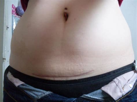 How Big Is A C Section Cut Dimensions Guide