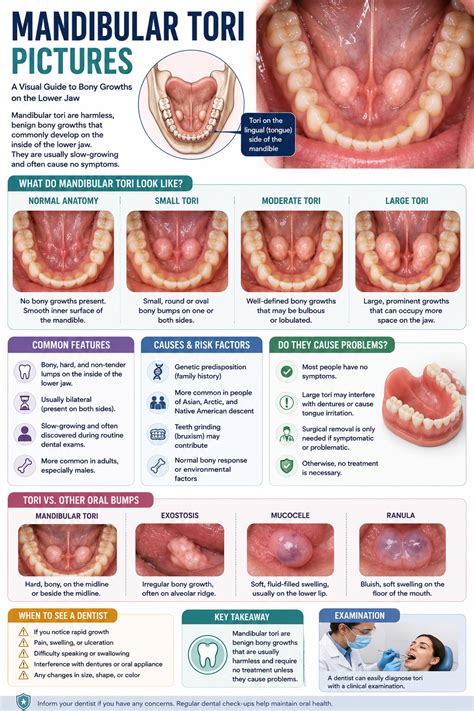 Mandibular Tori Pictures A Doctors Visual Guide