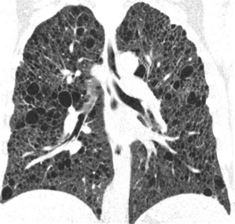 Mrcp Part 2 Neurology Flashcards Quizlet