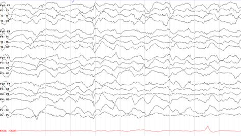 Slowing And Other Non Epileptiform Abnormalities