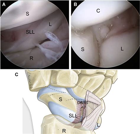 Scapholunate Ligament Anatomy Scapholunate Ligament Repair Eorif