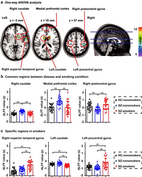 Statistical Analysis Of Brain Regions With Significant Differences In