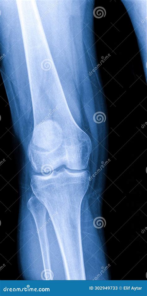 Knee Joint X Ray Ap And Lateral View Fracture And Displacement Of The Patella Bone Or Knee Cap