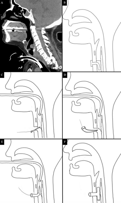 Computerized Tomography Of Occlusion And Visualization Of Novel Repair Download Scientific