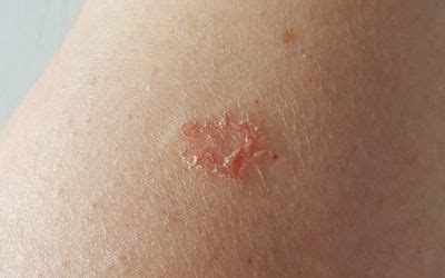 How To Manage Eczema Prevent Spreading With Good Skin Care