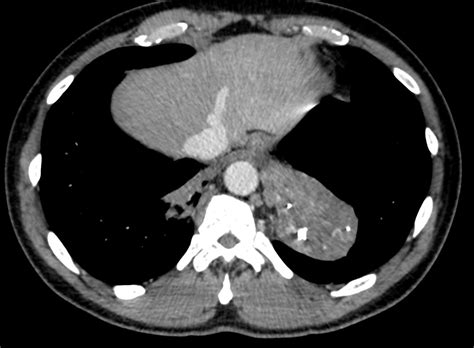 111lu Extralobar Sequestration Bilateral The Common Vein