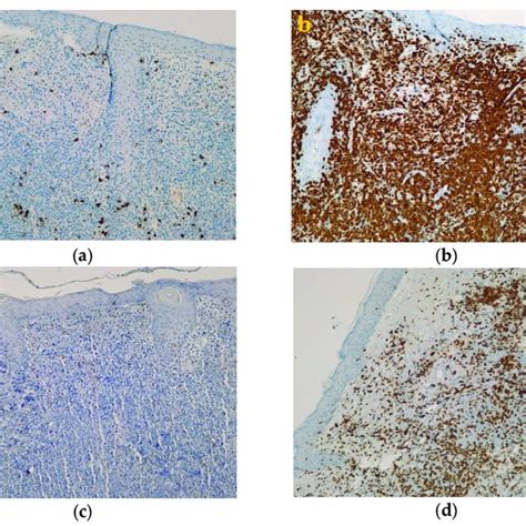The Skin Microenvironment In Mf Progression A Normal Skin B Patch And