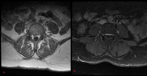 Lumbar Spine Mri Axial