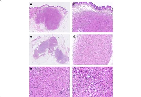Scanning Image Of Mass Of Right Labium Majus Epidermis Displayed A