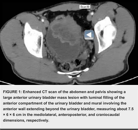 Figure 1 From A Huge Hemangioma Of The Urinary Bladder A Case Report