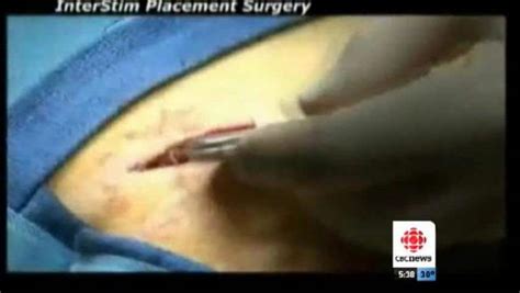 Ottawa Man To Get A Pacemaker — For His Bladder Cbc News