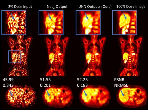 Visual Comparison Of Low Count Denoised Images Generated Using