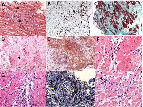 Diagnosis And Treatment Of Myocarditis And Inflammatory Cardiomyopathy