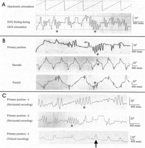 Electro Oculographic Eog Findings Of The Cases These Show The Ocular Download Scientific