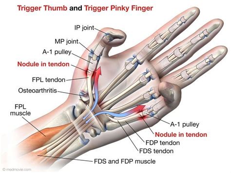 Trigger Finger Fort Worth Tx The Hand To Shoulder Center